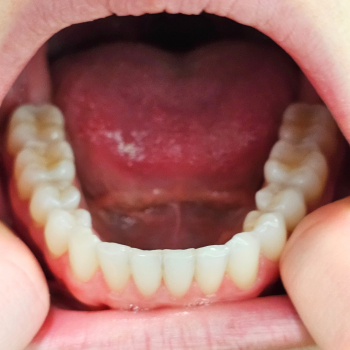 Invisalign Quote Online - Sammamish Orthodontics