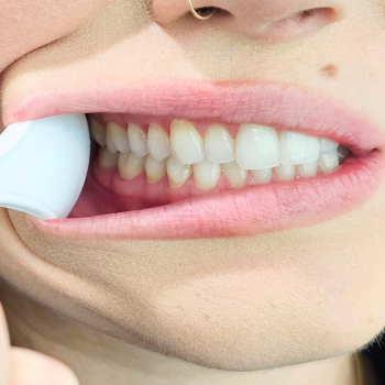 Invisalign Quote Online - Sammamish Orthodontics